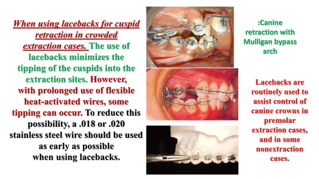 MBT wire sequence during orthodontic alignment and leveling | PPTX ...