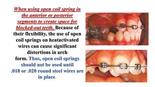 MBT wire sequence during orthodontic alignment and leveling | PPTX