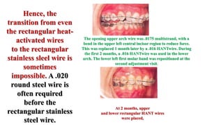 MBT wire sequence during orthodontic alignment and leveling | PPTX
