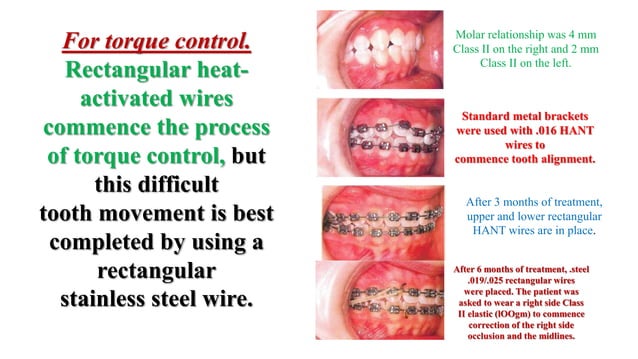 MBT wire sequence during orthodontic alignment and leveling | PPTX | Dental Health | Diseases ...