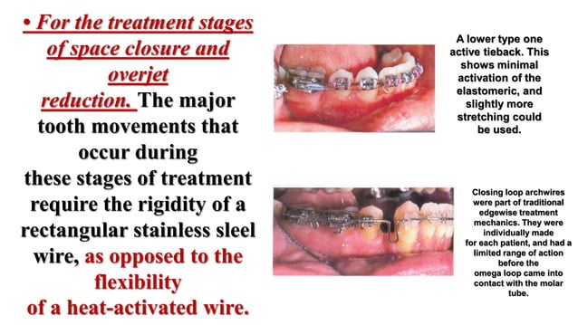 MBT wire sequence during orthodontic alignment and leveling | PPTX ...