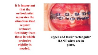 MBT wire sequence during orthodontic alignment and leveling | PPTX