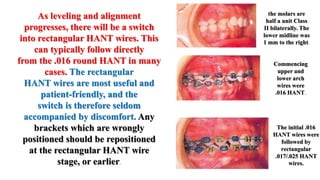 MBT wire sequence during orthodontic alignment and leveling | PPTX