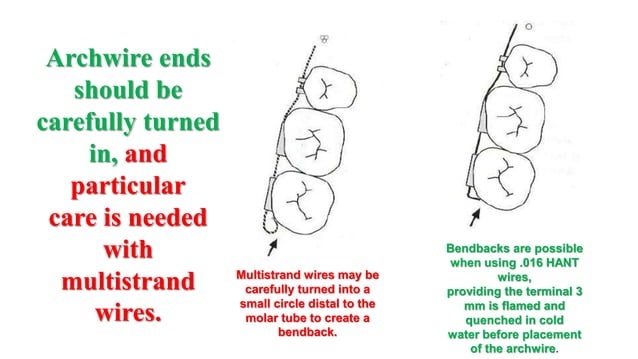 MBT wire sequence during orthodontic alignment and leveling | PPTX ...