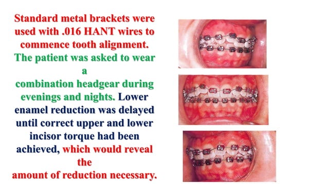 MBT wire sequence during orthodontic alignment and leveling | PPTX ...
