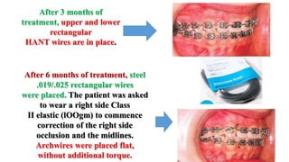 MBT wire sequence during orthodontic alignment and leveling | PPTX