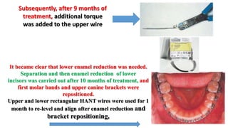 MBT wire sequence during orthodontic alignment and leveling | PPTX