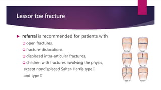 Toe fracture | PPTX