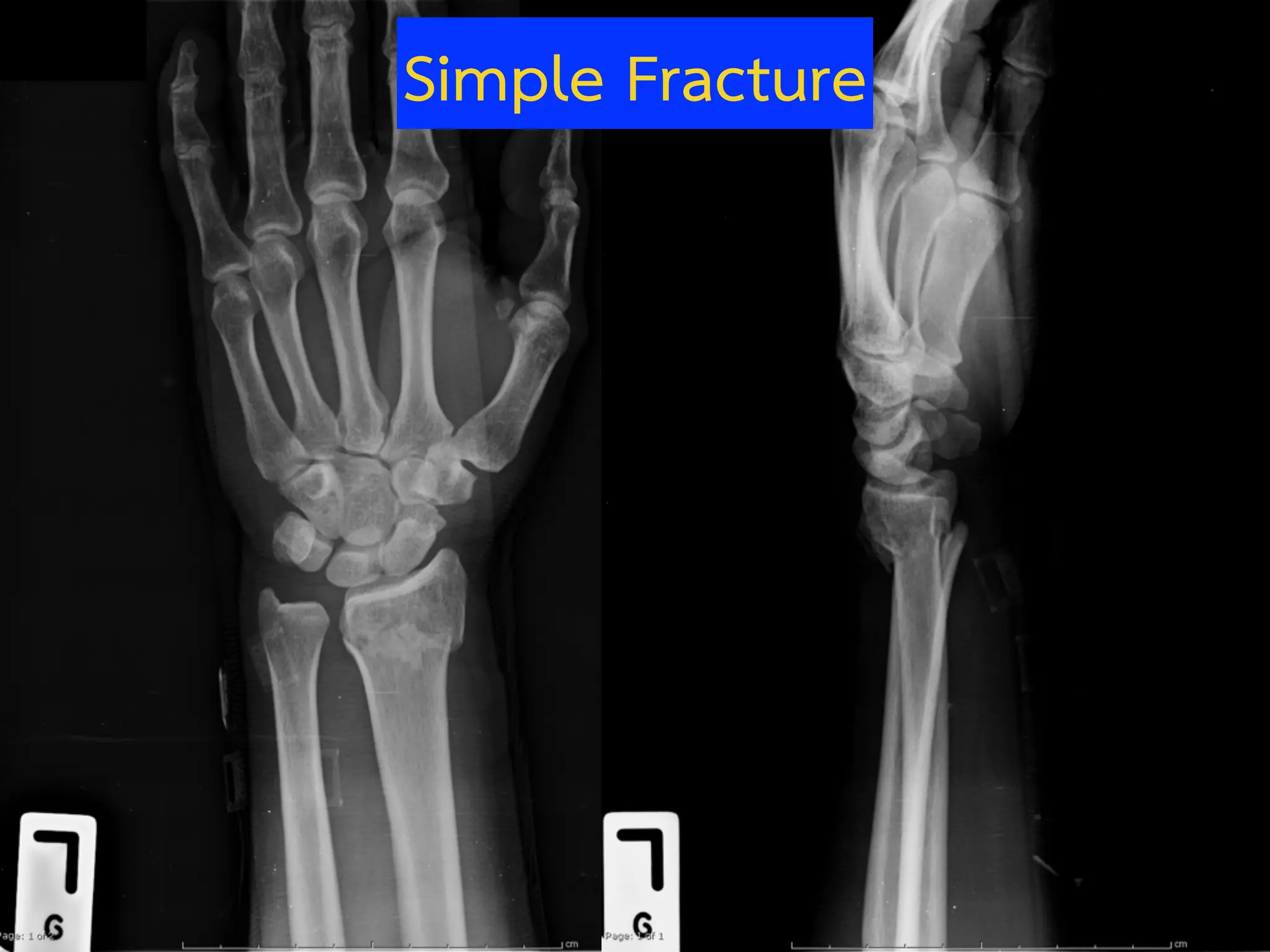 Common Hand Injury | PPT