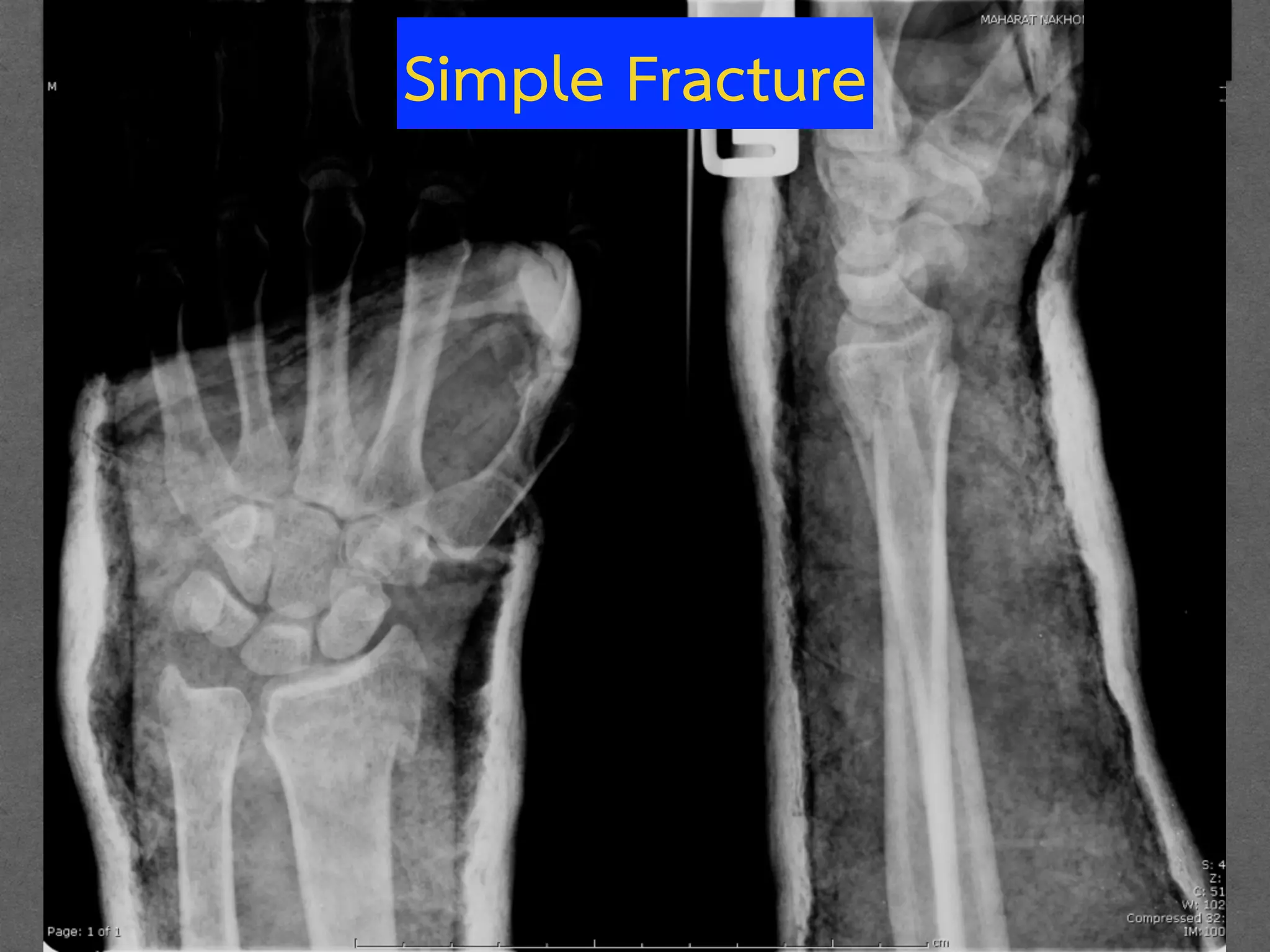 Common Hand Injury | PPT