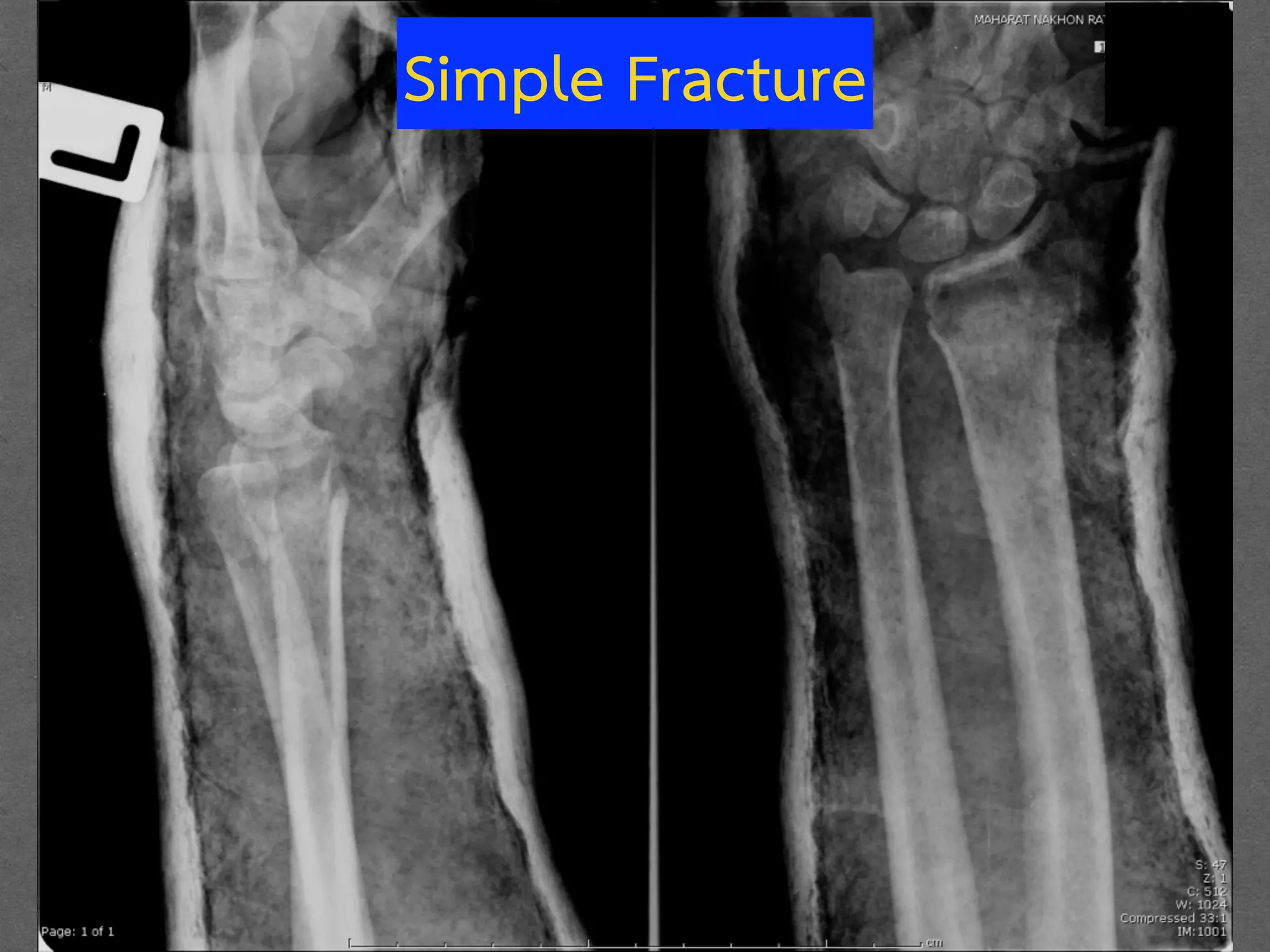 Common Hand Injury | PPT