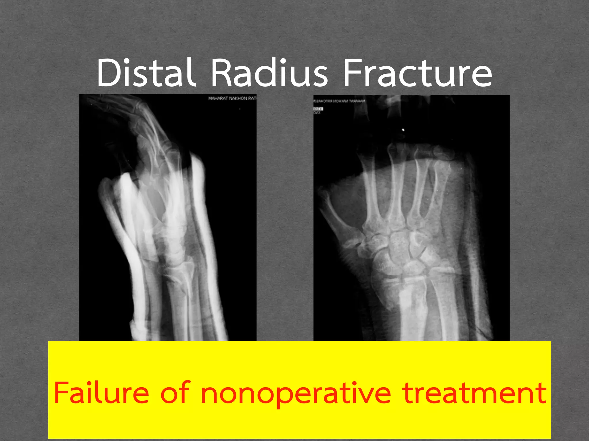 Common Hand Injury | PPT