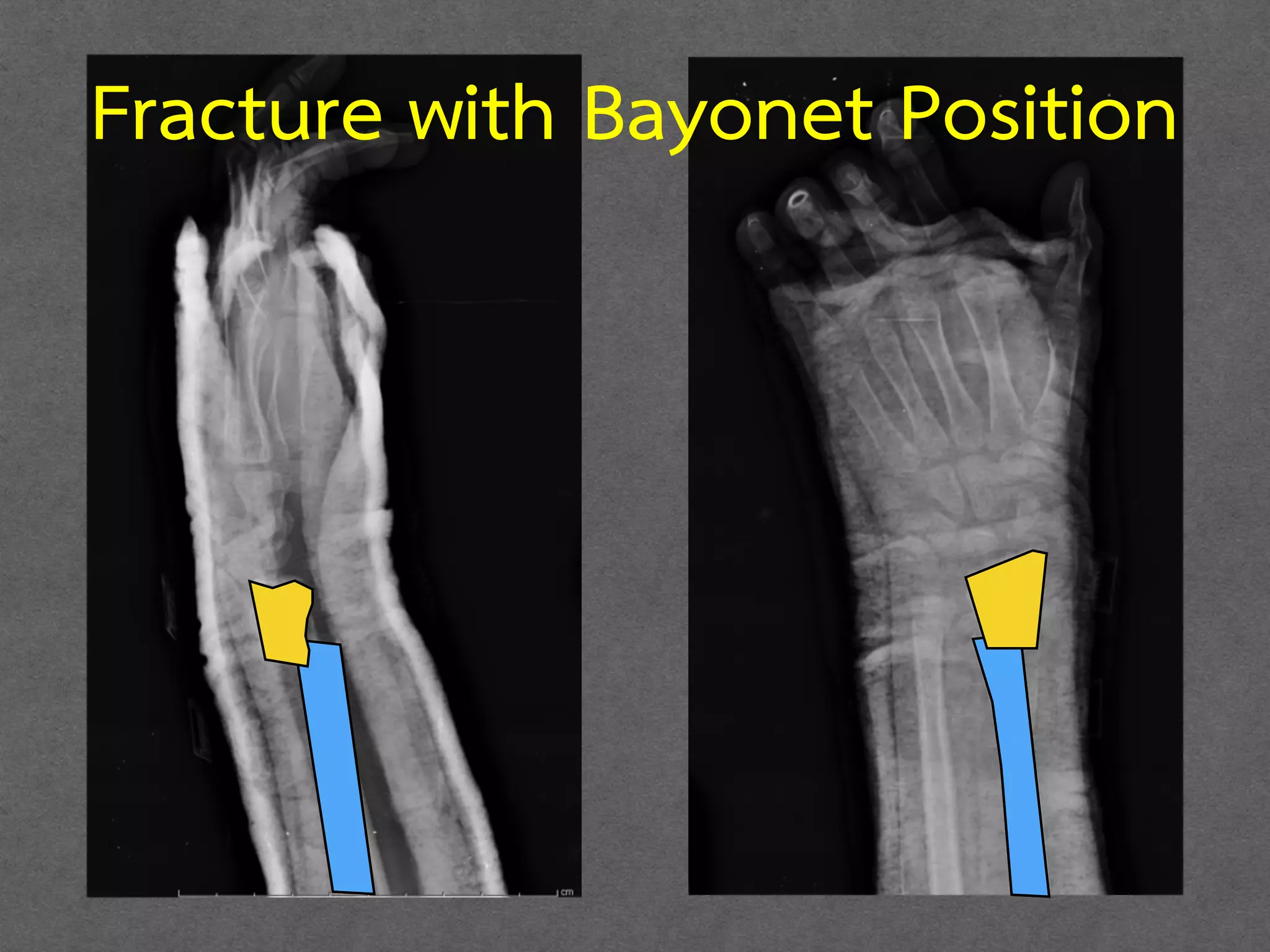 Common Hand Injury | PPT