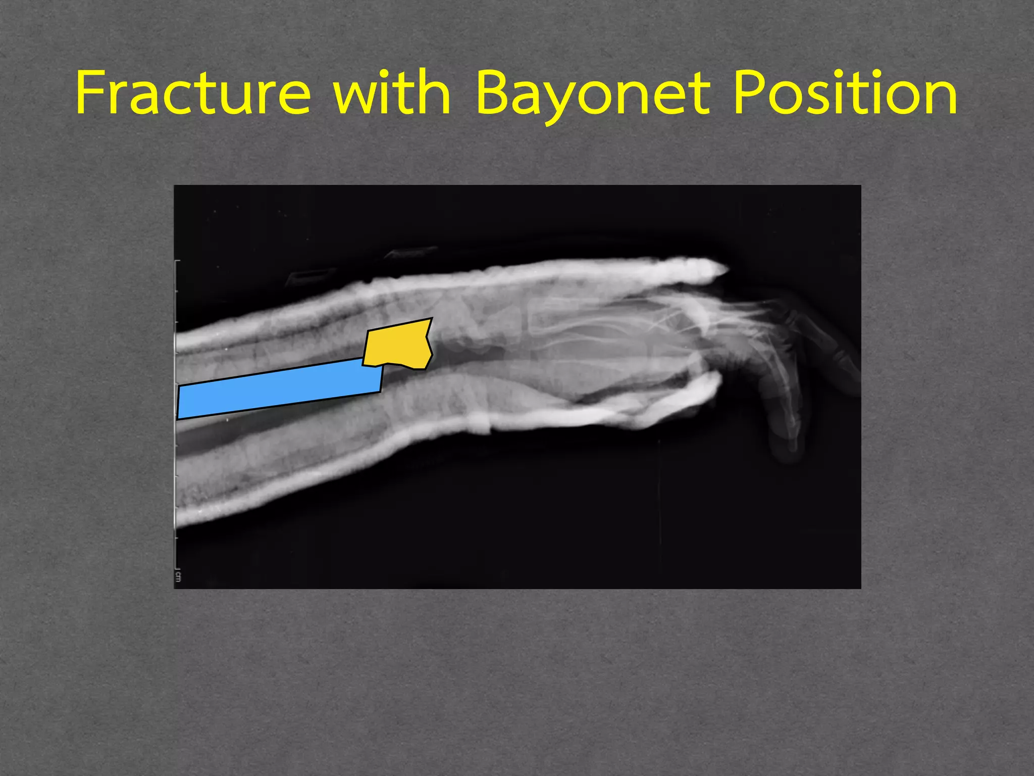 Common Hand Injury | PPT