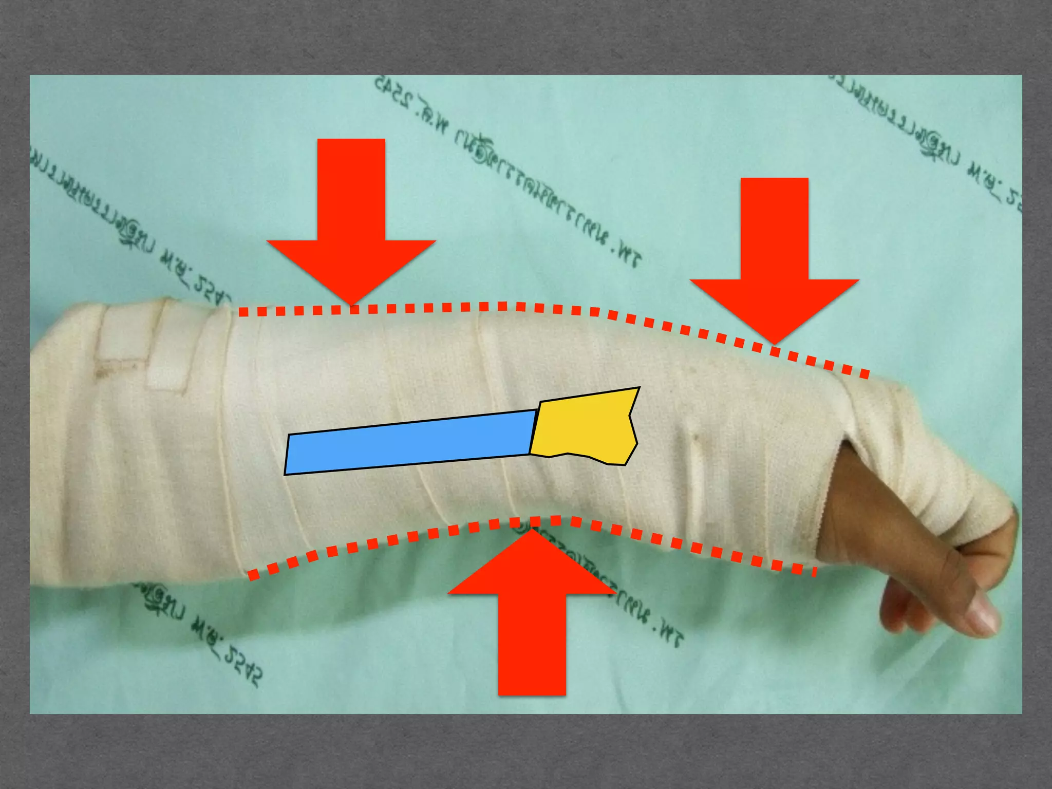 Common Hand Injury | PPT