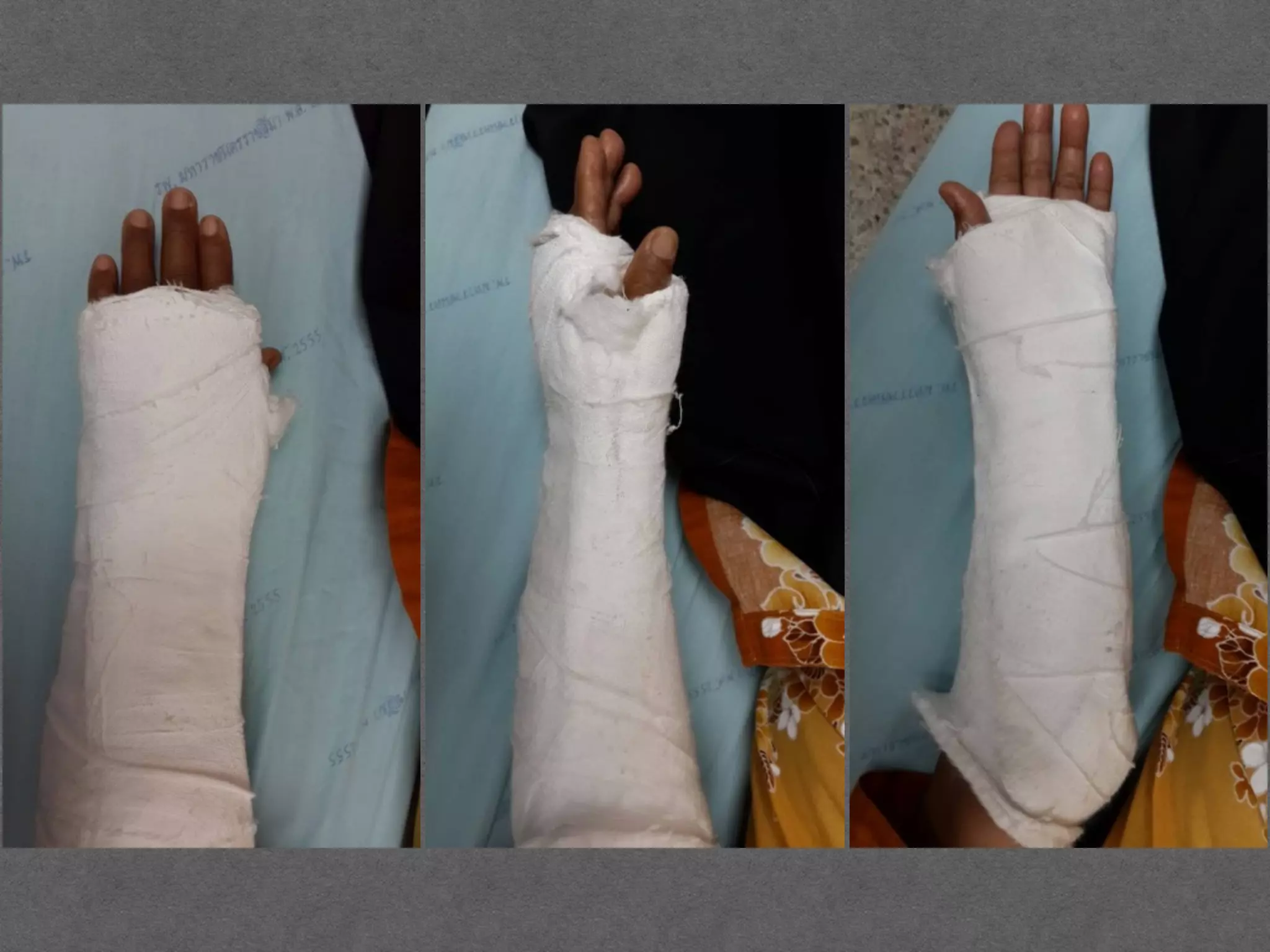 Common Hand Injury | PPT