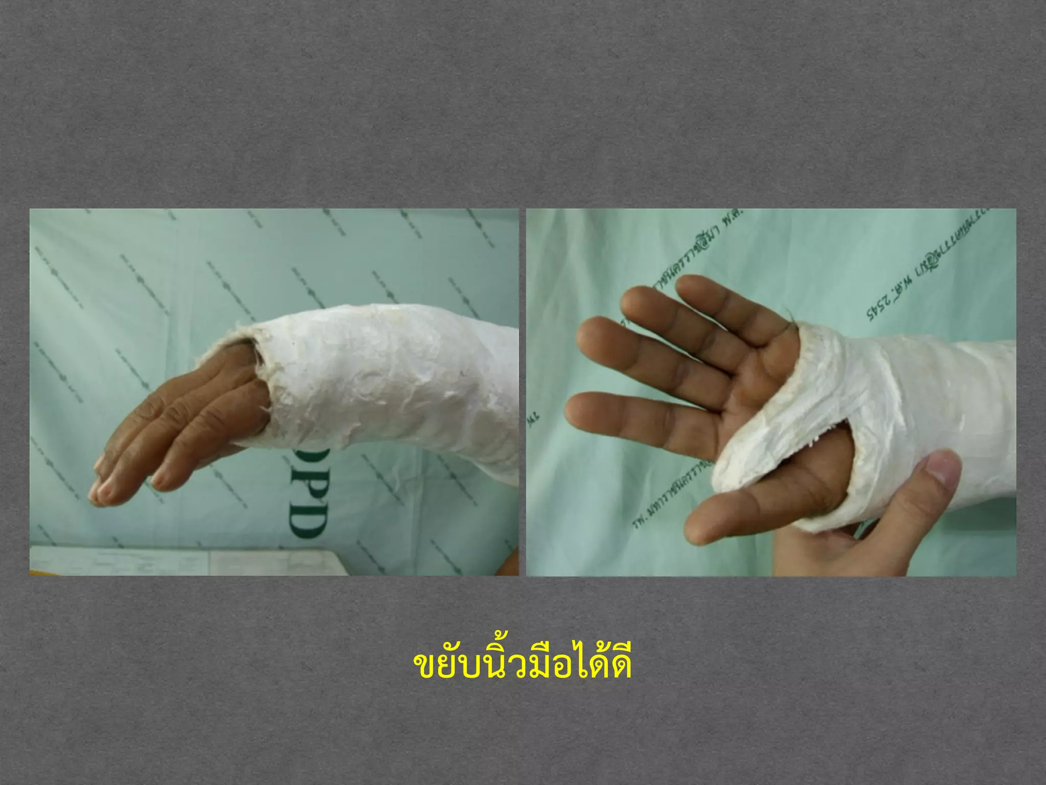 Common Hand Injury | PPT