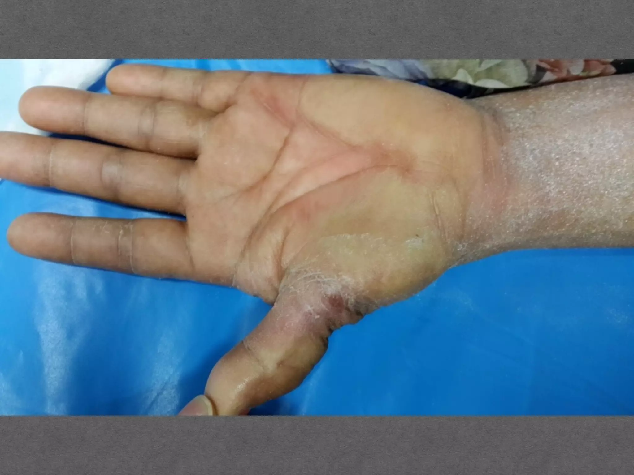 Common Hand Injury | PPT