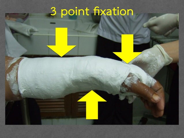 Common Hand Injury | PPT