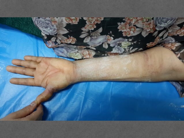 Common Hand Injury | PPT