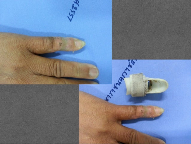 Common Hand Injury