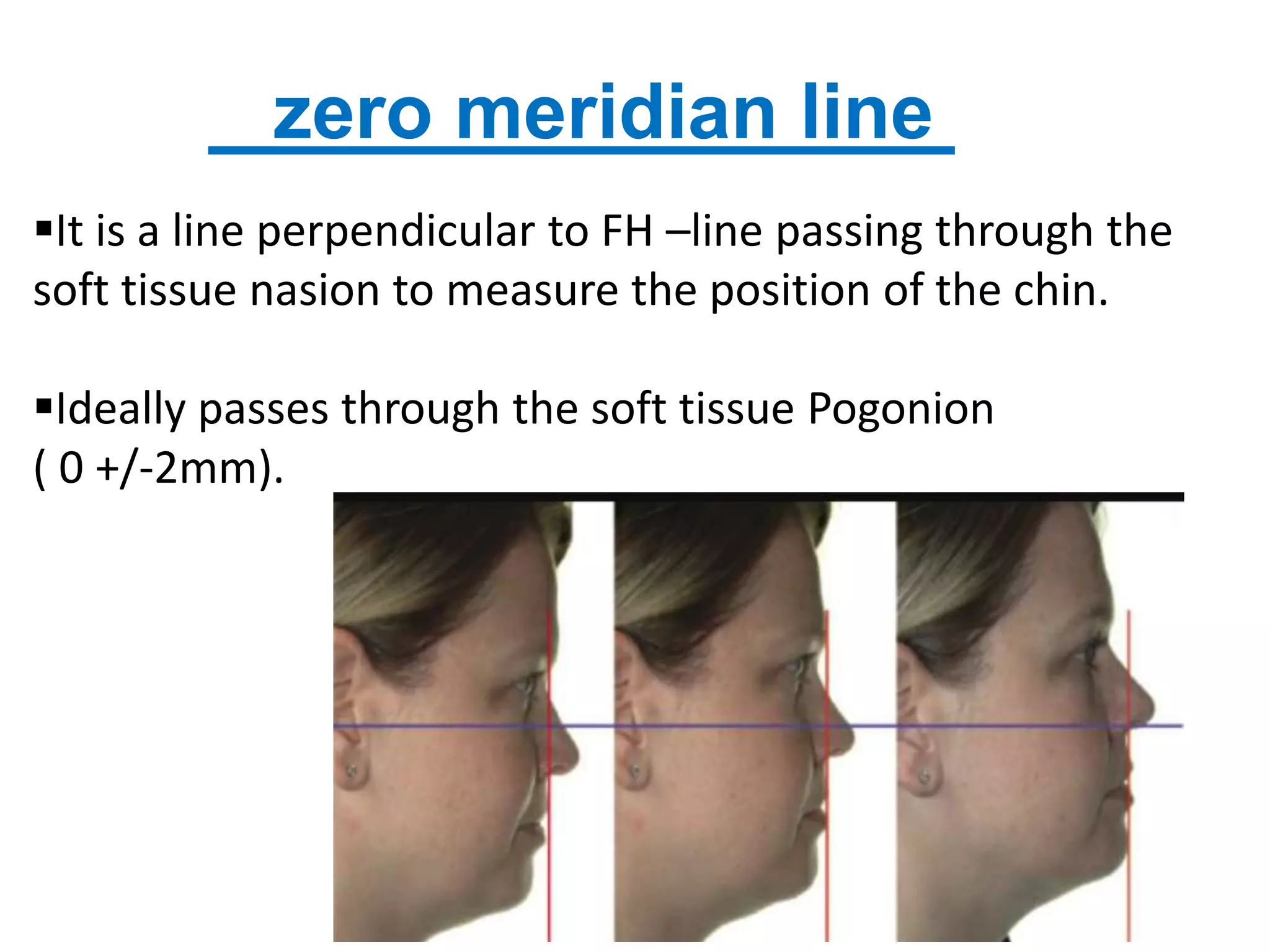 Orthognathic surgery | PPTX