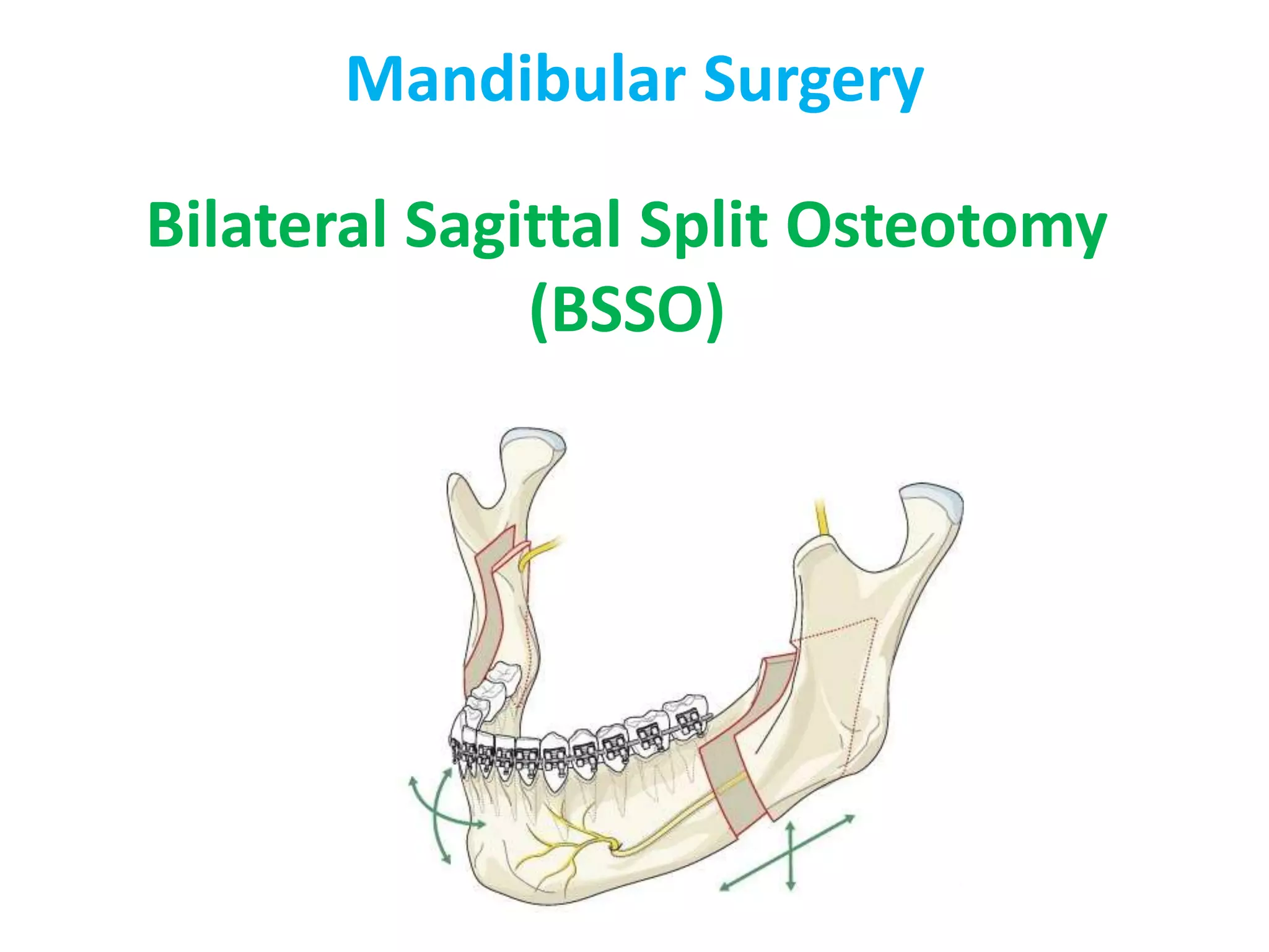 Orthognathic surgery