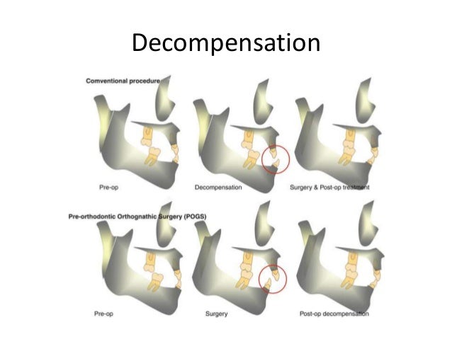 Orthognathic surgery