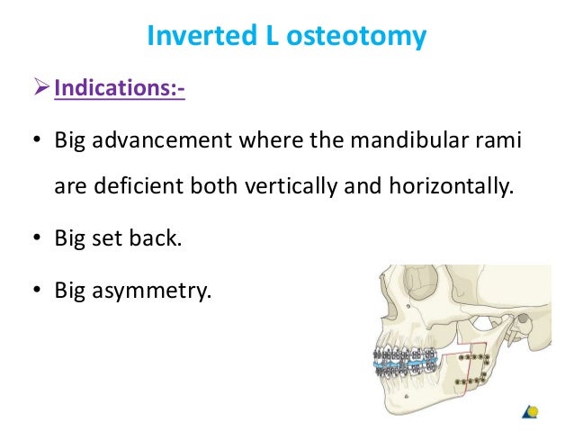 Orthognathic surgery