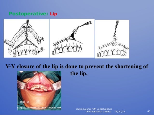 complications in orthognathic surgey