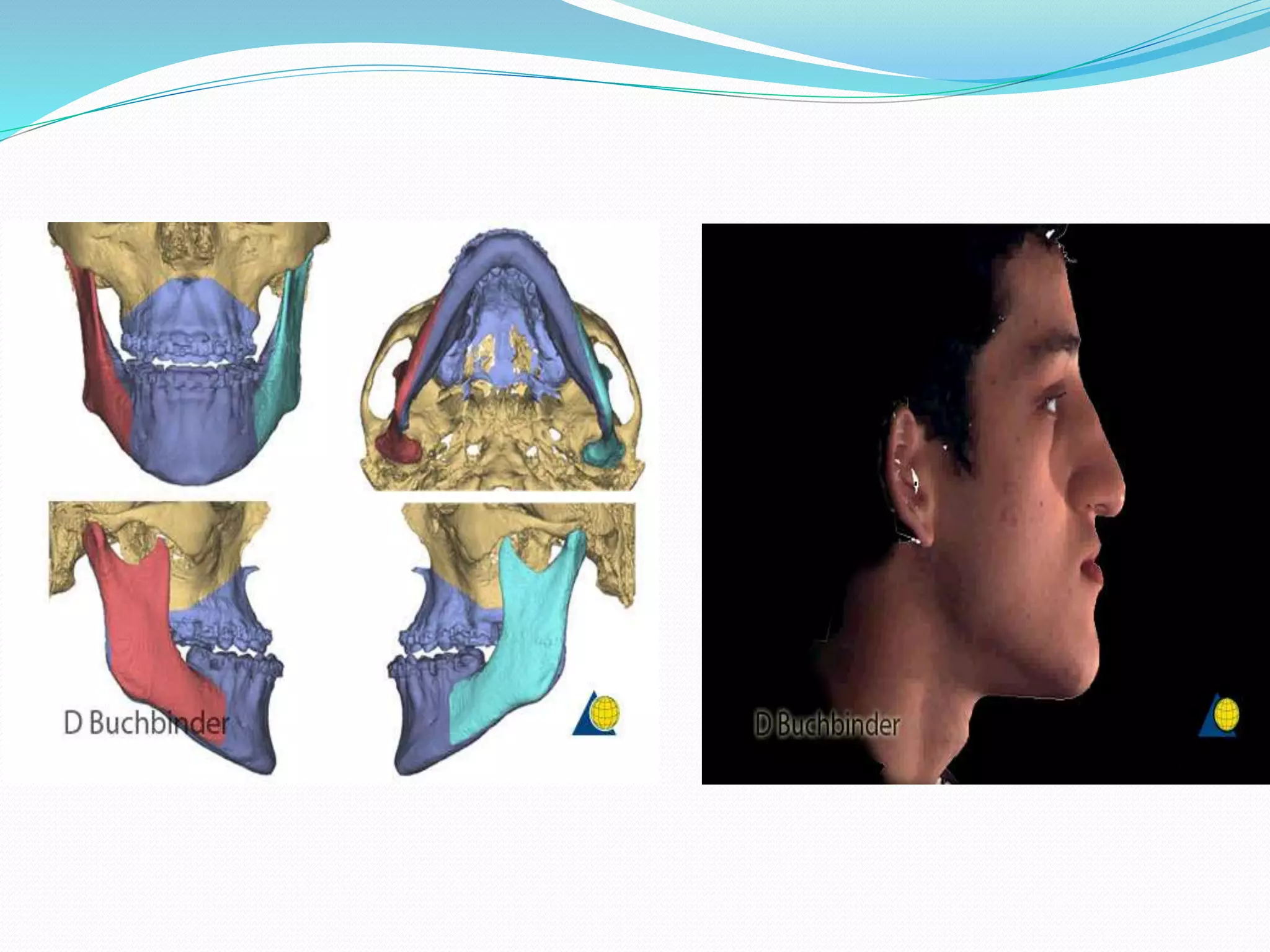 Orthognathic Positioning System | PPTX