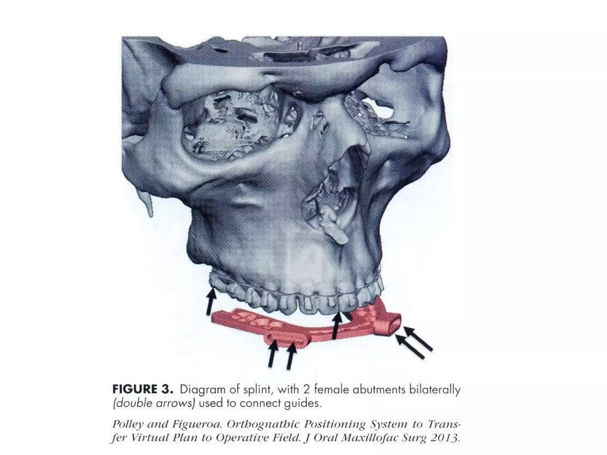 Orthognathic Positioning System | PPTX