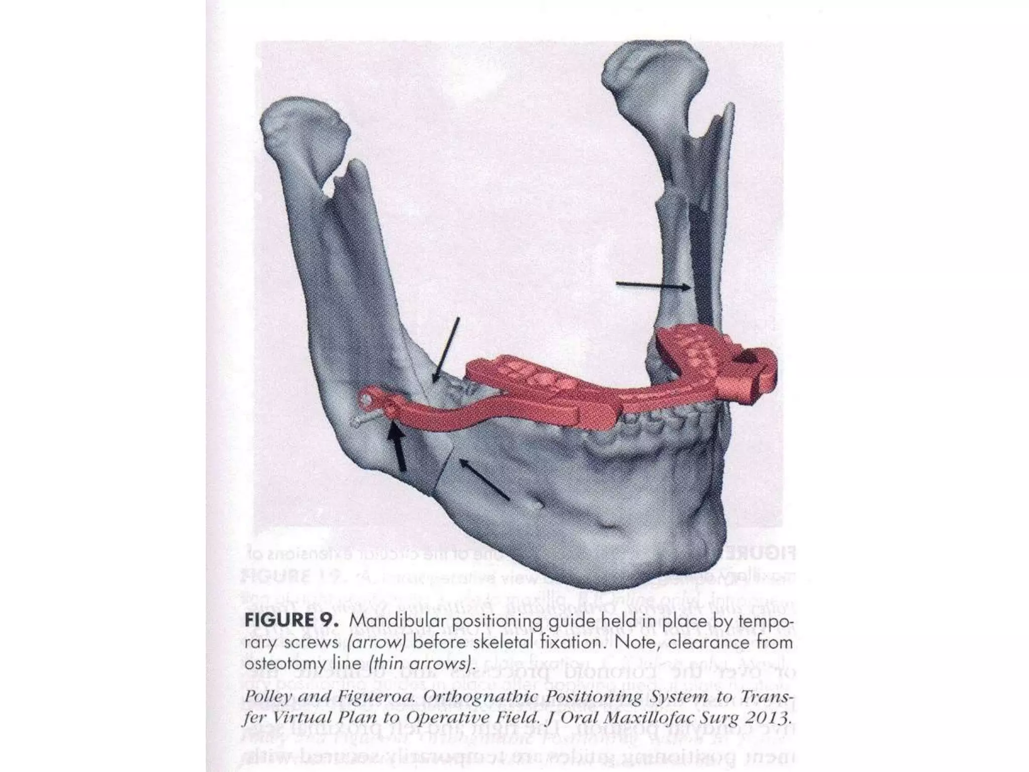 Orthognathic Positioning System | PPTX