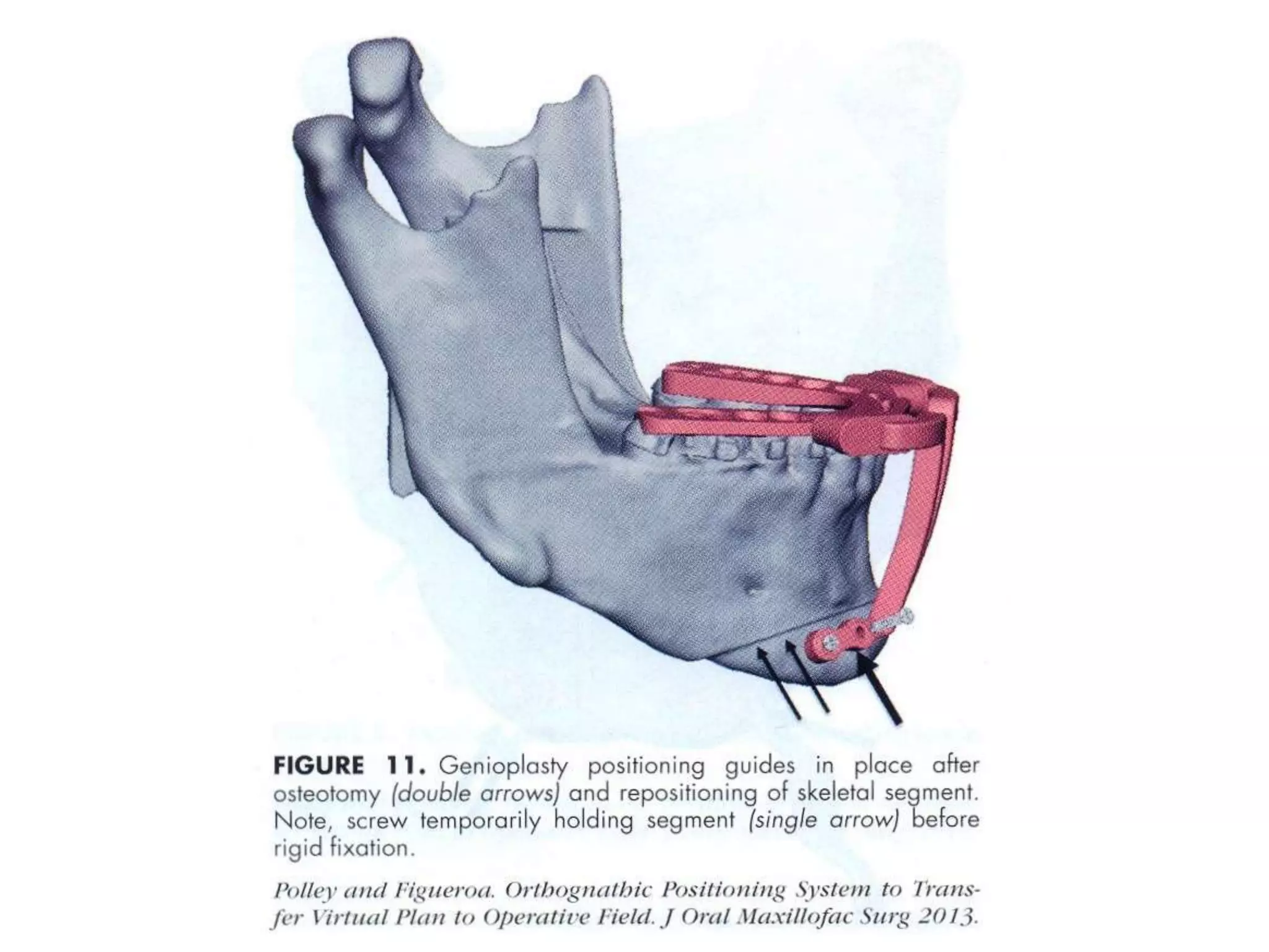 Orthognathic Positioning System | PPTX