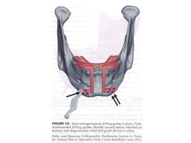 Orthognathic Positioning System | PPTX
