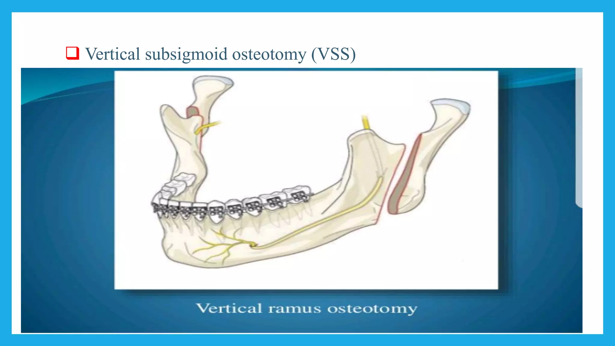Orthognathic surgery / Dr.Sarah alkhateeb | PPTX