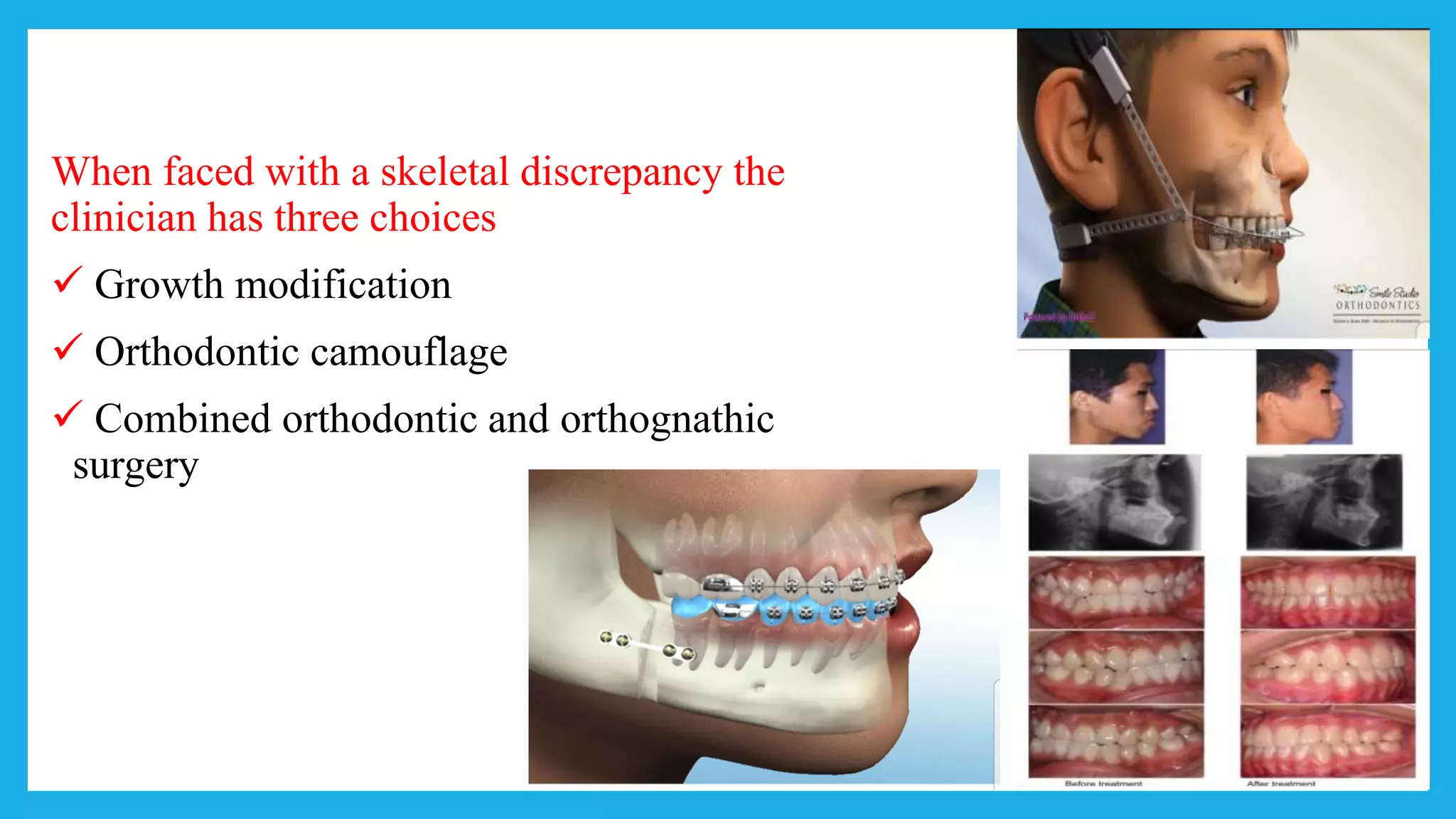 Orthognathic surgery / Dr.Sarah alkhateeb | PPTX