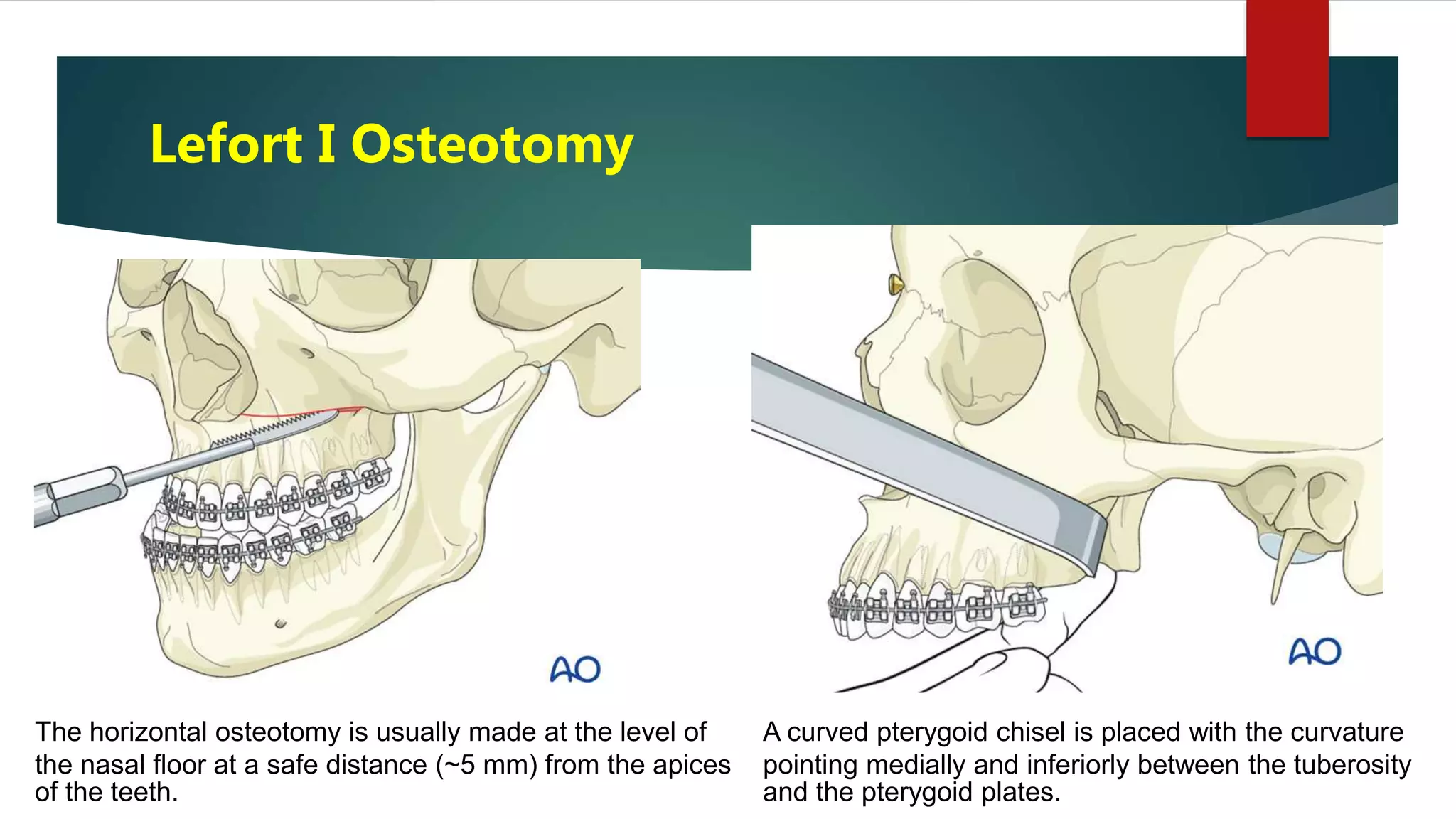 Orthognathic surgery | PPTX
