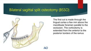 Orthognathic surgery | PPT