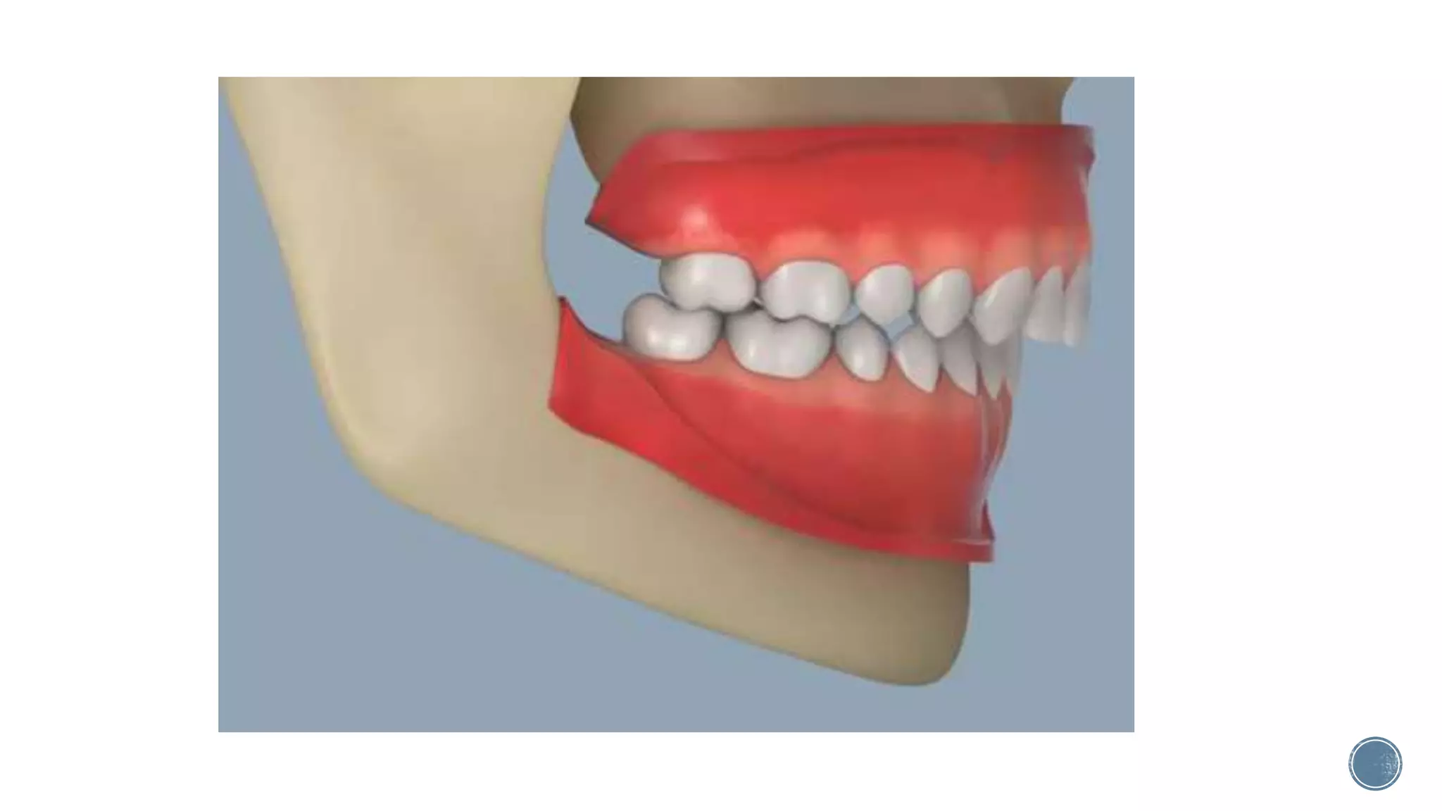 Orthognathic surgery ... | PPTX