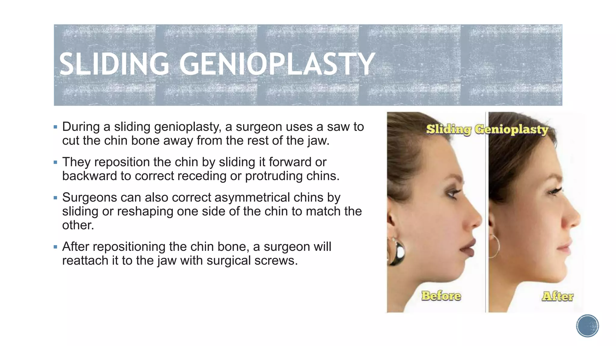 Orthognathic surgery ... | PPTX