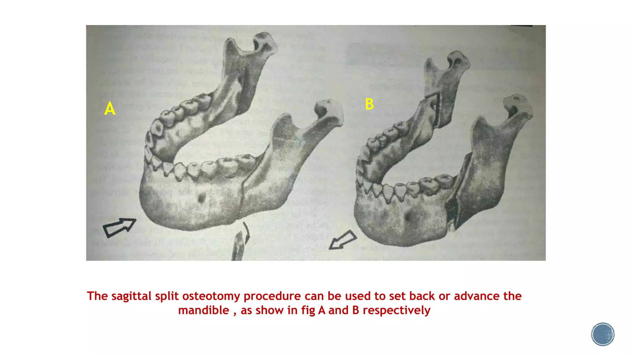 Orthognathic surgery ... | PPTX