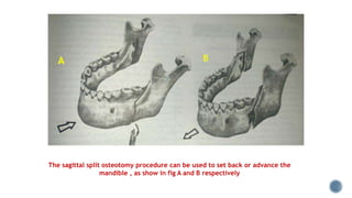 Orthognathic surgery ... | PPTX