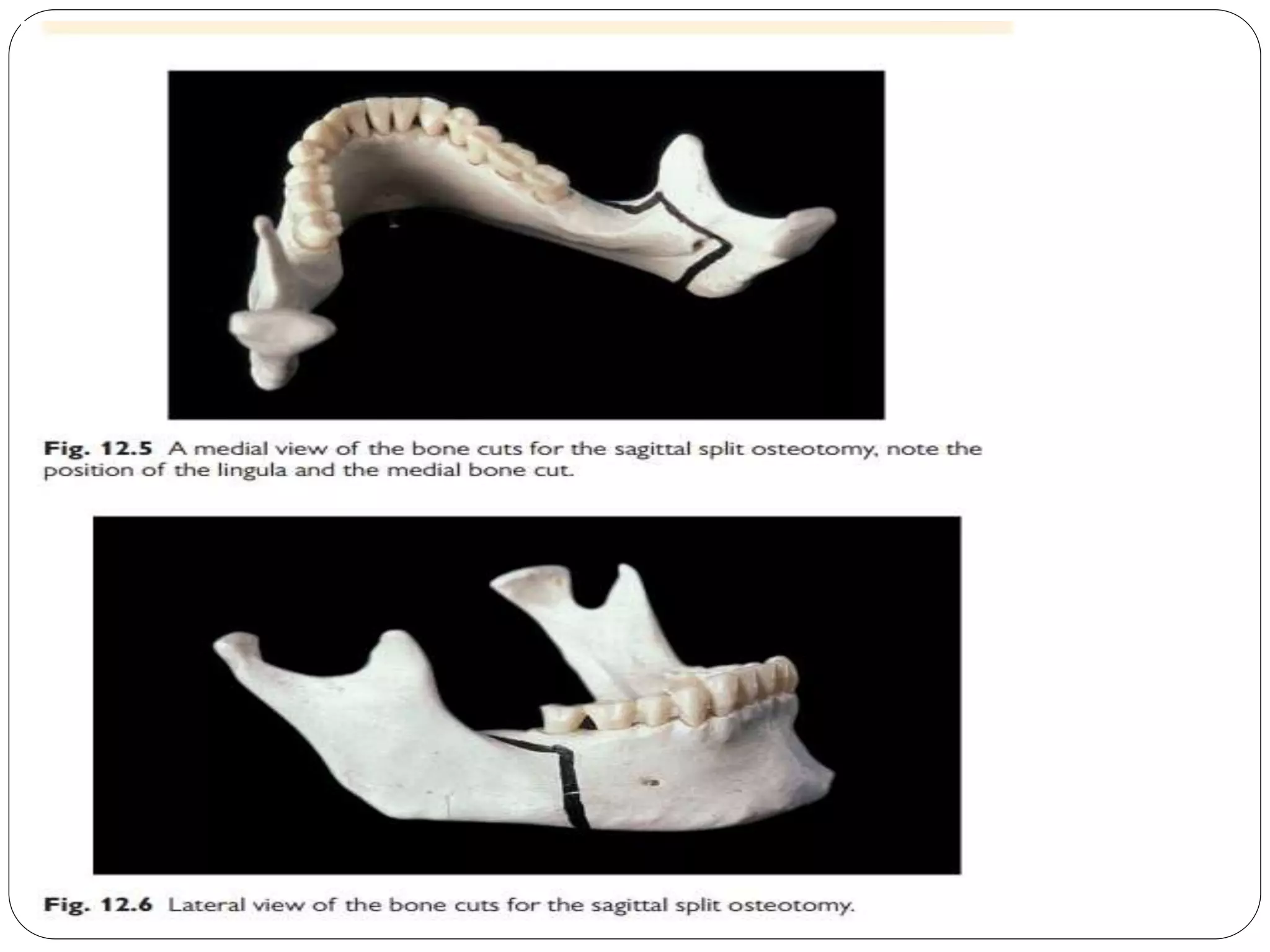ORTHOGNATHIC SURGERY.pptx