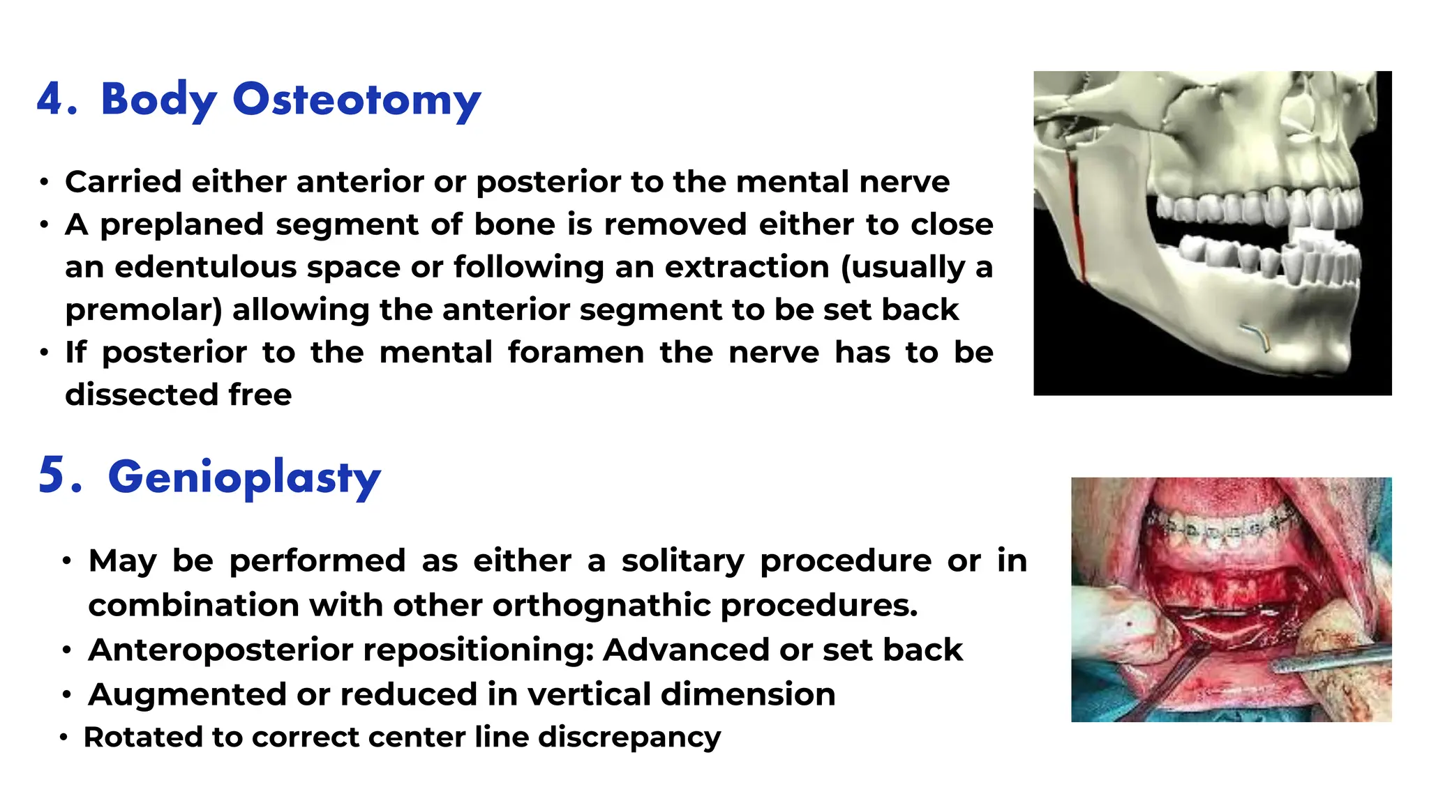 Orthognathic Surgery................pptx