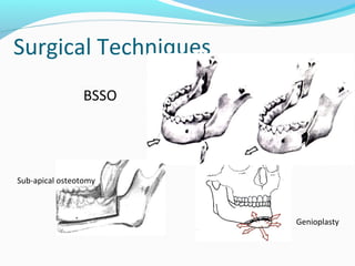 Orthognathic surgery new microsoft power point presentation | PPT