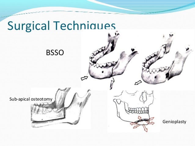 Orthognathic surgery new microsoft power point presentation
