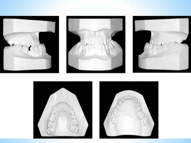 Orthognathic treatment for skeletal class iii malocclusion nehal fouad ...