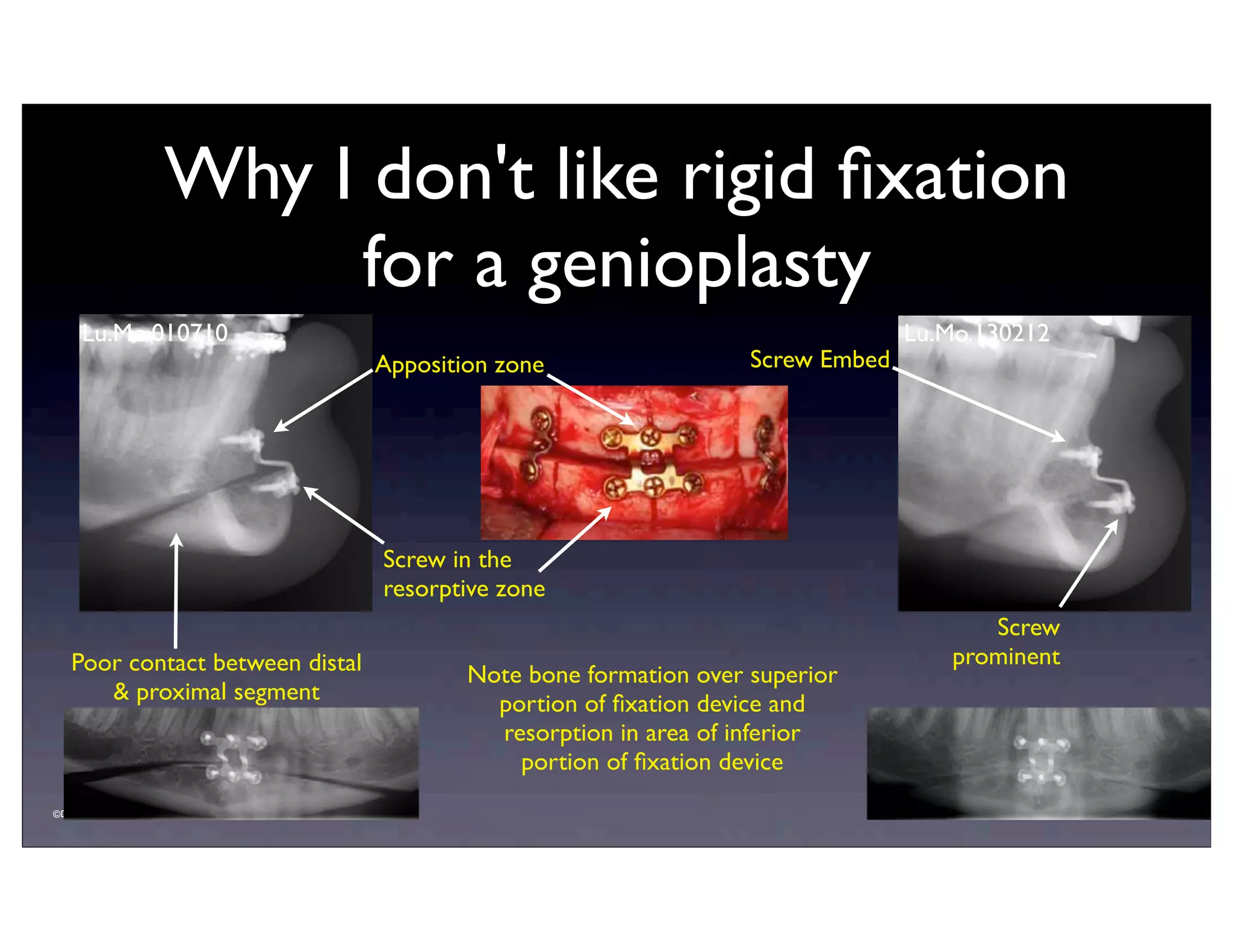 Orthognatic surgery chirurgie orthognathique | PDF