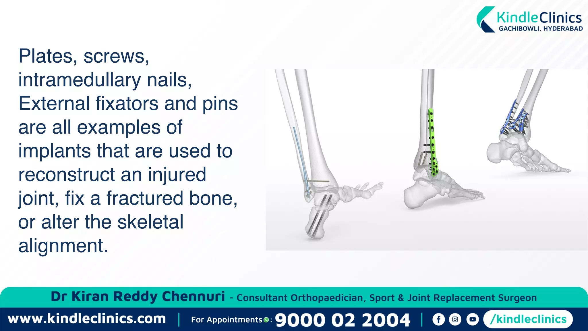 Types of Ortho Implants | PDF